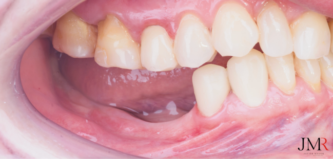 Caso de Javier Mayor Mayoral de Colgajo Lingual + Colgajo Vestibular ...